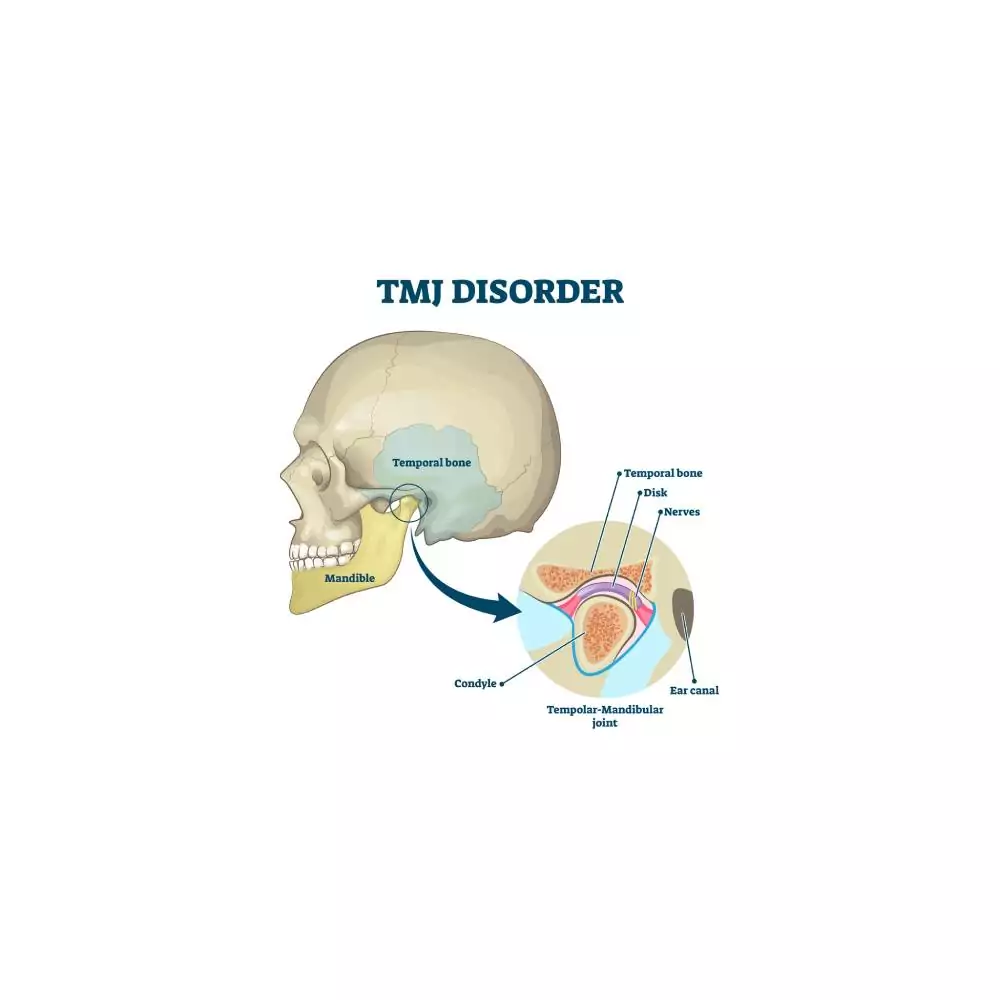 TMJ Disorder - Shreveport, LA - Shreveport Dental Solutions